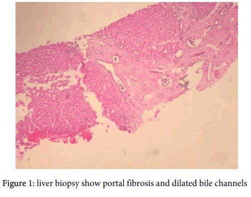 Congenital Hepatic Fibrosis Associated with Polycystic Kidney Disease