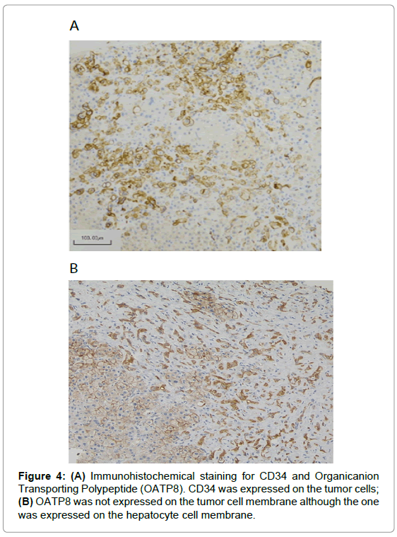 Hepatic Epithelioid Hemangioendothelioma: Vascular Penetration in