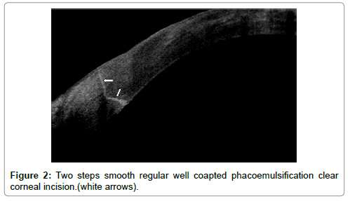 Corneal Incisions in Extracapsular Cataract Extraction Versus Pha
