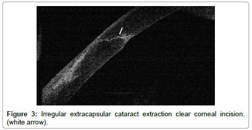Corneal Incisions in Extracapsular Cataract Extraction Versus Pha
