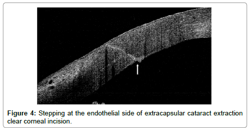 Corneal Incisions in Extracapsular Cataract Extraction Versus Pha