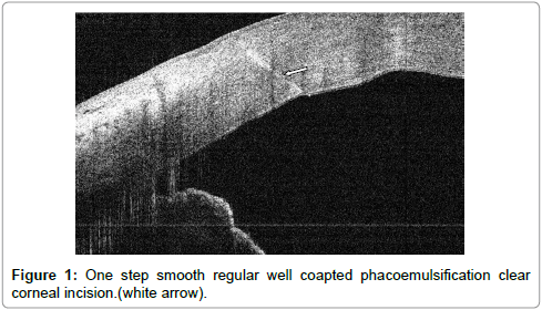 Corneal Incisions in Extracapsular Cataract Extraction Versus Pha