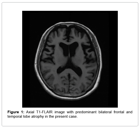 Behavioral-Variant Frontotemporal Neurocognitive Disorder Present