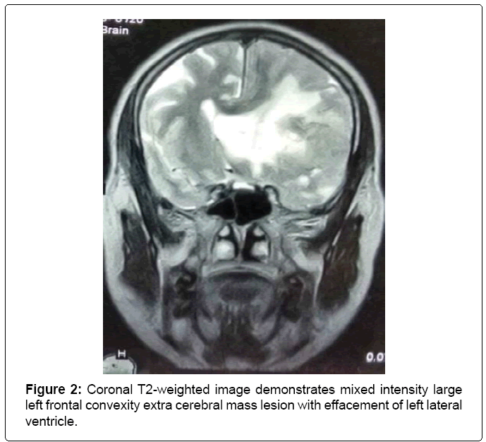 Frontal Lobe Meningioma Masquerading as Depressive Disorder