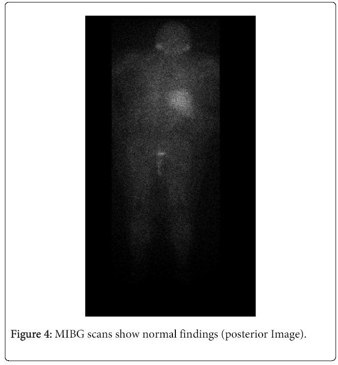 A Case of Pseudopheochromocytoma Associated with Clozapine Therap