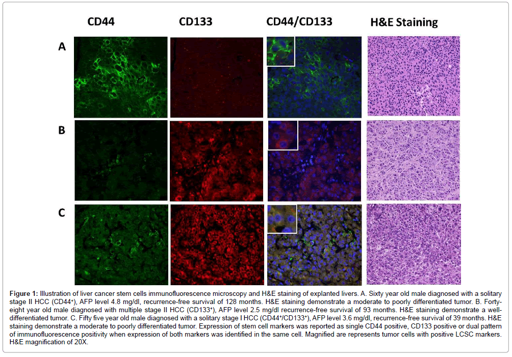 Liver Cancer Stem Cells: A New Paradigm for Hepatocellular Carcinoma ...