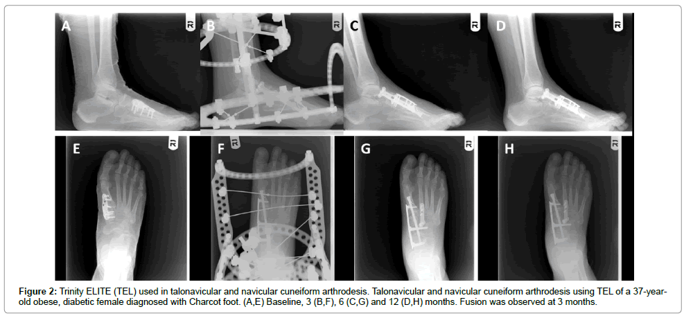 A Retrospective Clinical Comparison of Two Allogeneic Bone Matrices ...