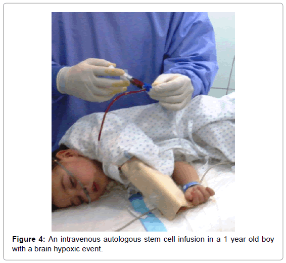 How to Maximize the Success of Stem Cell Autografts for Neuroregeneration