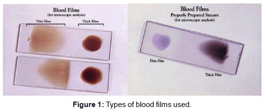 Malaria Case (Early Detection)