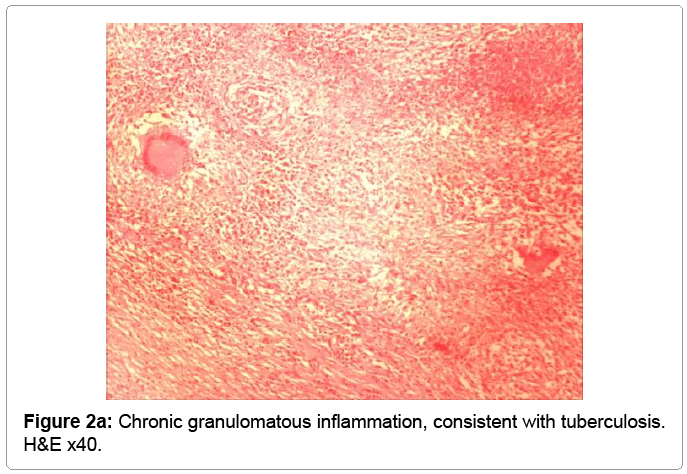 Tuberculous Axillary Lymphadenopathy: A Case Report