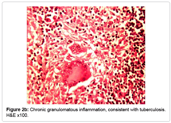 Tuberculous Axillary Lymphadenopathy: A Case Report