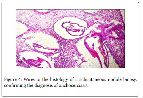 Onchocerciasis: A Reality in Western Burkina Faso in 2016