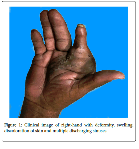 Maduromycosis of Hand: A Rare Form of Chronic Granulomatous Infection ...