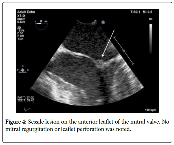 Salmonella enteritidis Concurrent Spinal Epidural Abscess, Urinar