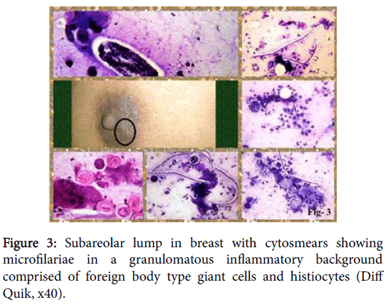 Microfilariae in Fine Needle Aspirates From a Coastal District of India ...