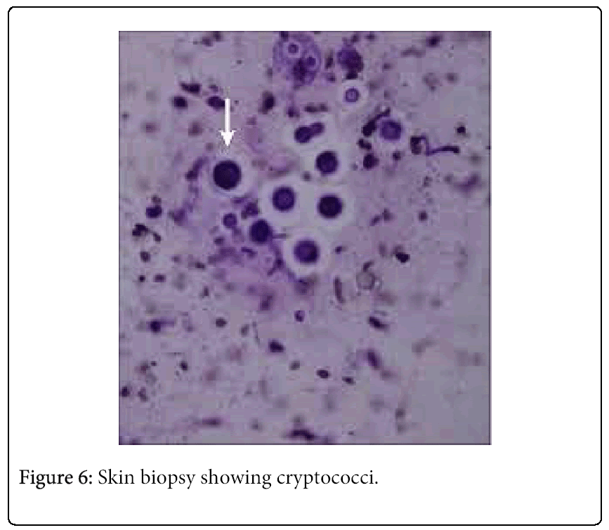 An Unusual Presentation of Disseminated Cryptococcosis in a Middl