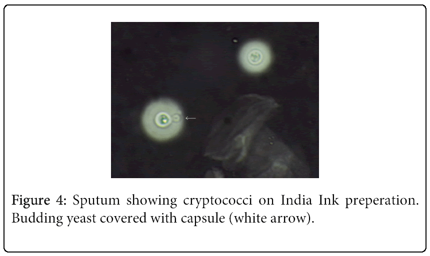 An Unusual Presentation of Disseminated Cryptococcosis in a Middl