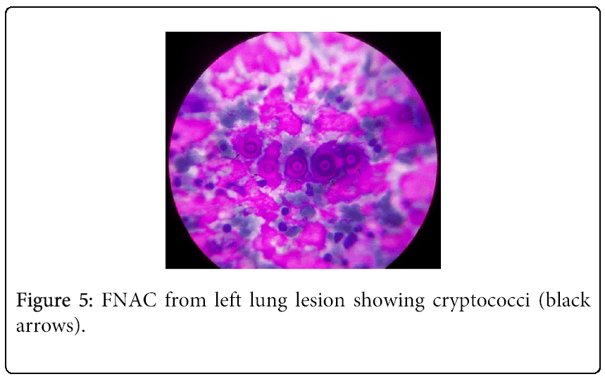 An Unusual Presentation of Disseminated Cryptococcosis in a Middl