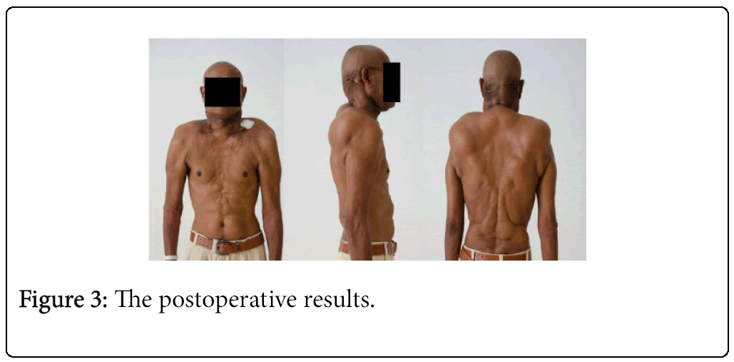 Multiple Symmetrical Lipomatosis in a 67-Year Old African Male: F