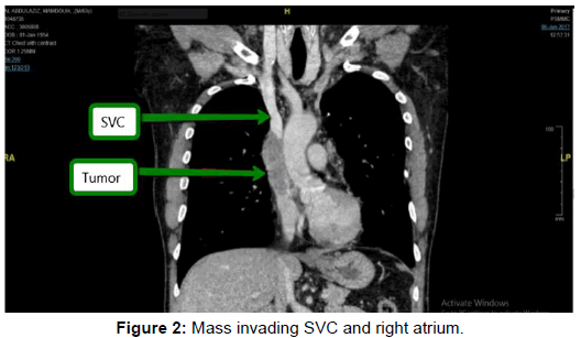 Thymoma Inducing Superior Vena Caval Syndrome