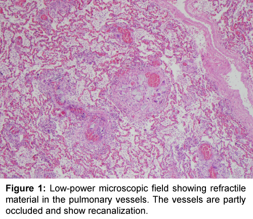 Acute Pulmonary Vascular Talcosis: Mimicking Acute Pulmonary Embo