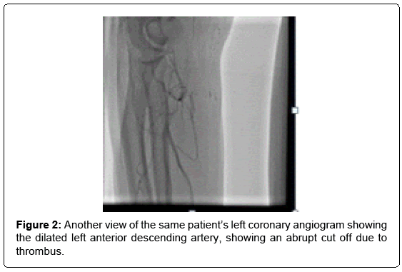 Why is an IABP not the Answer to Cardiogenic Shock after Percutan