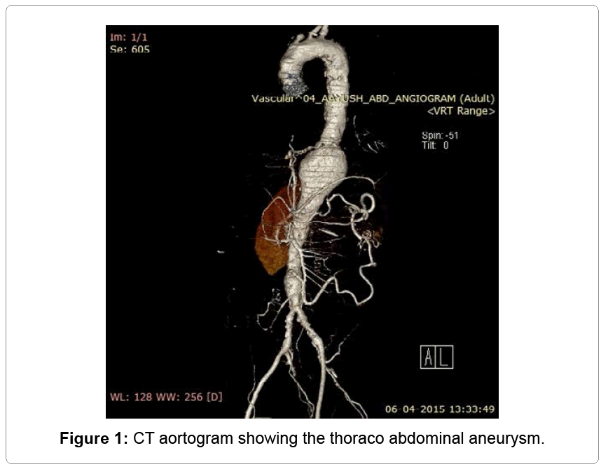 A Unique Case of Endovascular Repair of Aortic Aneurysm