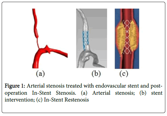 Research of Numerical Simulation of Biomechanics on In-stent-restenosis