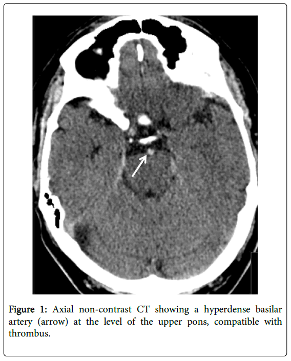 Prompt Recanalizaton of Basilar Artery (Lazarus Effect) in Patien