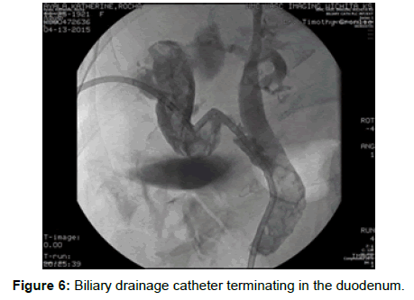 A Novel Approach: Trans-Cholecyctic PTC and Malignant Biliary Ste