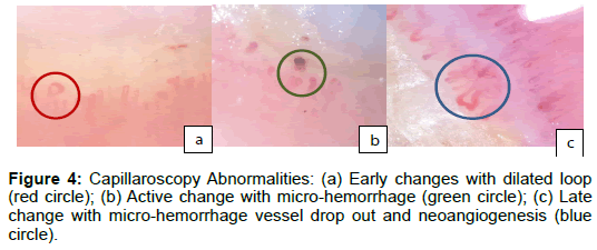 Nailfold Capillaroscopy: An Important Clinical Tool for the Vascu