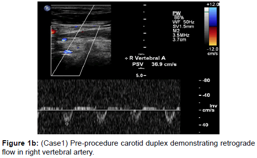 Double Steal Syndrome: Two Case Presentations