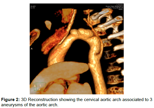 Surgical Repair of a Pseudocoarctation with Cervical Aortic Arch