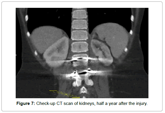 Flank Incision Laparotomy Approach for Repair of Traumatic Left Renal ...