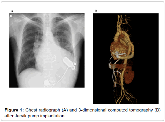 Jarvik 2000 Implantation in Anatomical Right Ventricle on Patient