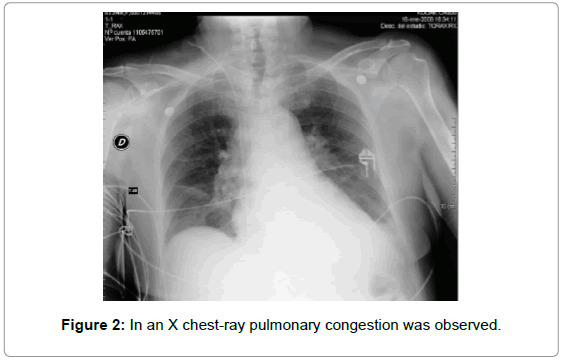 Transient Left Ventricular Outflow Obstruction in Tako Tsubo- Syndrome ...