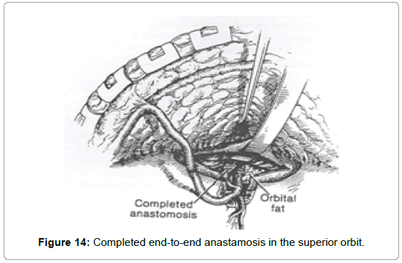 New Methods of Diagnosis and Treatment of Ophthalmic Artery Stenosis in ...