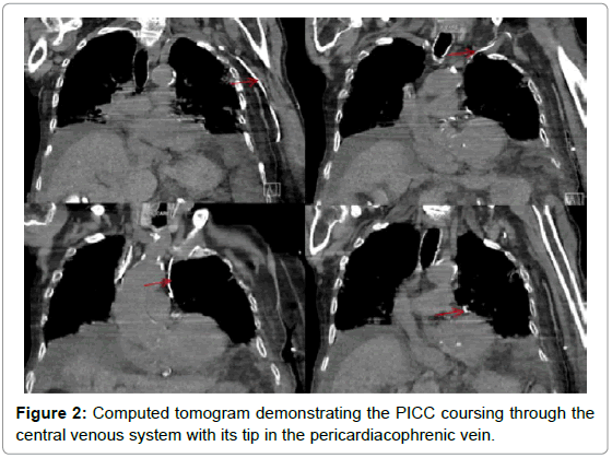 PICC’ing Your Way into the Pericardium: A Potential Catastrophic ...