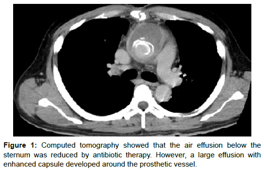 Successful Management of Refractory Prosthetic Vessel Infection ...
