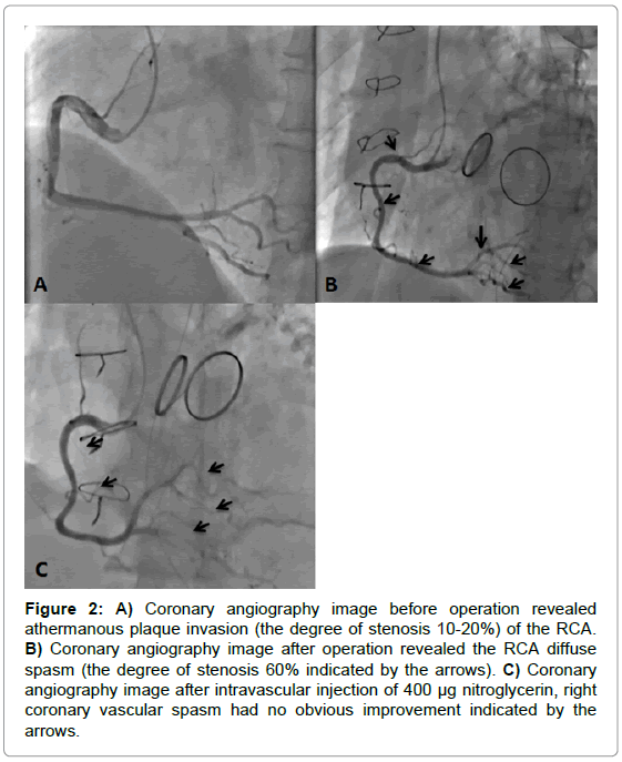 Coronary Artery Spasm is a Nightmare: A Rare Case of Multi Vessel ...