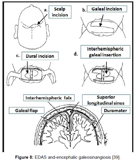 Moyamoya Disease in Childs and Adults: A Review of Surgical Treatment