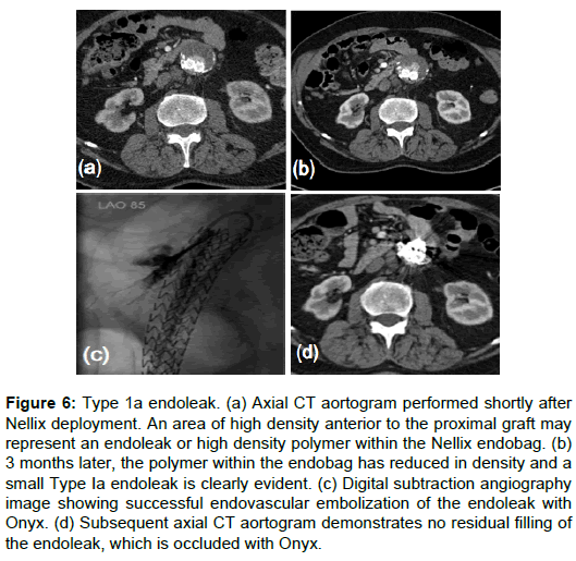 Nellix Endovascular Aneurysm Sealing System (EVAS): A New Concept in ...