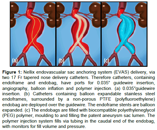 Nellix Endovascular Aneurysm Sealing System (EVAS): A New Concept in ...