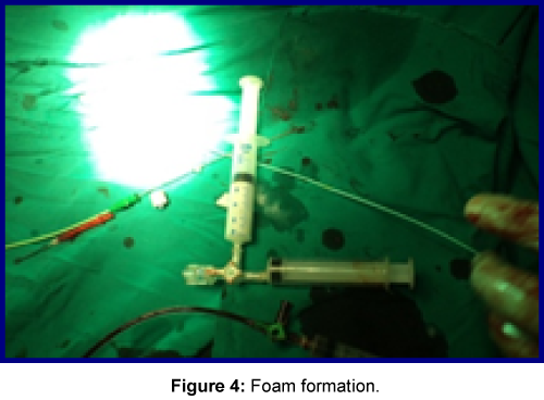 Color Duplex Ultrasound-Guided Foam Sclerotherapy: An Approach in the ...