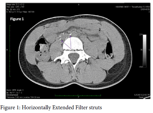 Inferior Vena Cava Filter Fragmentation, Embolization and Erosion