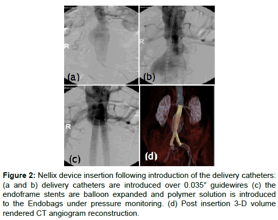 Nellix Endovascular Aneurysm Sealing System (EVAS): A New Concept