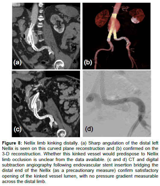 Nellix Endovascular Aneurysm Sealing System (EVAS): A New Concept