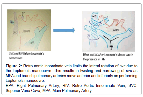 Rare Outcome of Lecompte’s Maneuver: SVC Compression due to