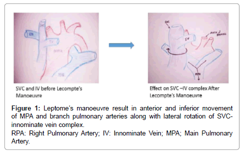Rare Outcome of Lecompte’s Maneuver: SVC Compression due to