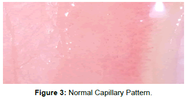 Nailfold Capillaroscopy: An Important Clinical Tool for the Vascu